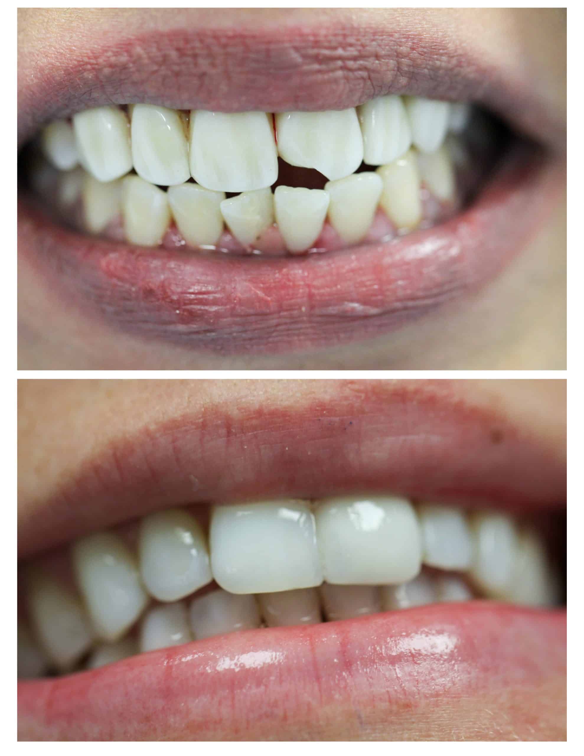 Tooth Crown Before And After